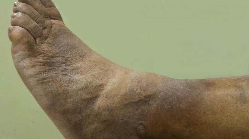 8 Surprising Cellulitis Facts | Is Cellulitis Contagious?