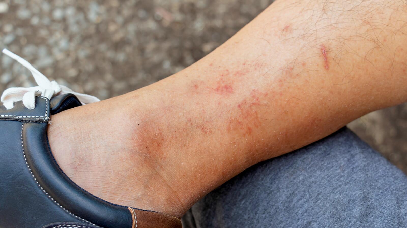Rash on Legs: Causes and Treatment Rash on Legs: Causes and Treatment
