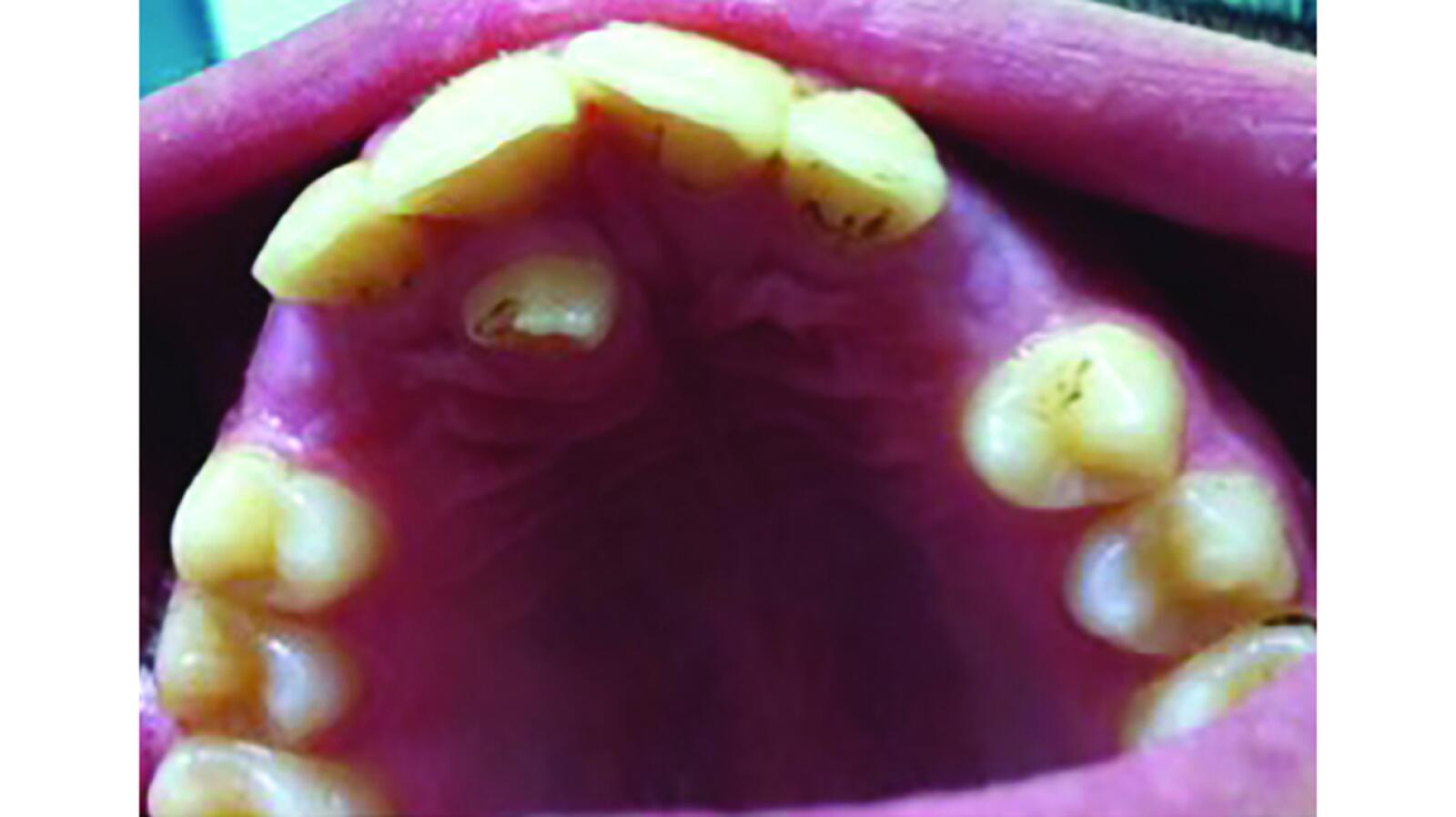 Mesiodens: Definition, Causes, Treatment, and More