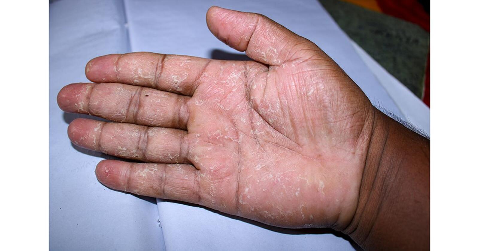 Rash On Palms: Causes, Treatments, and More