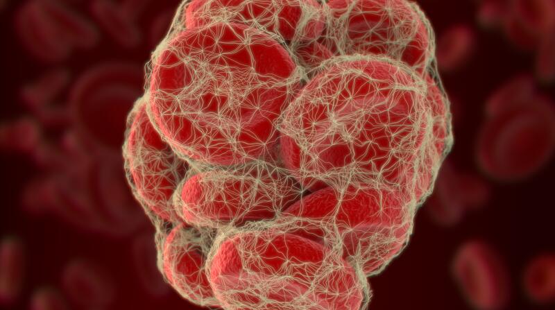 9 Things to Know About Pulmonary Embolism (PE) Symptoms & Treatment