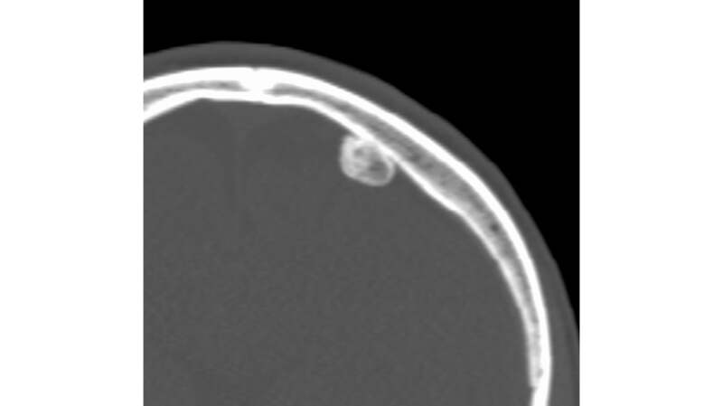 Osteoma: Symptoms, Causes, Treatment, and More