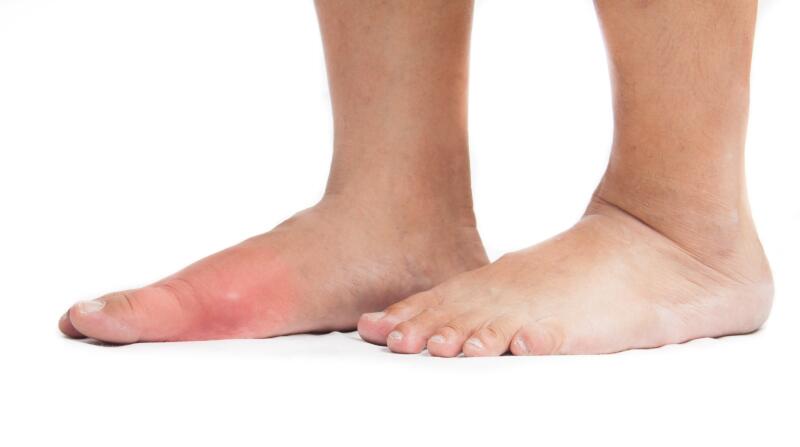 What Gout Looks Like