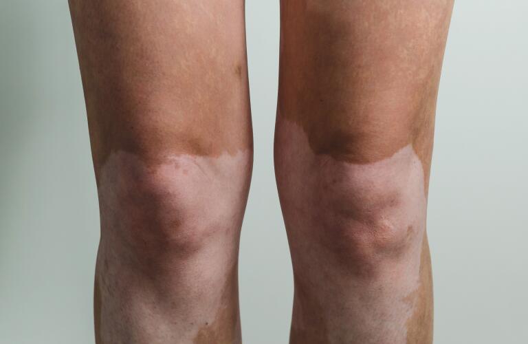 vitiligo menopause
