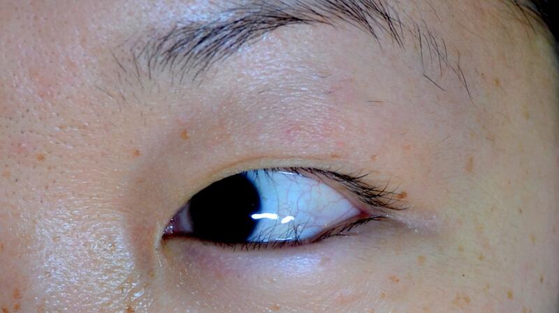 Entropion: Symptoms, Types, Causes, and Treatment