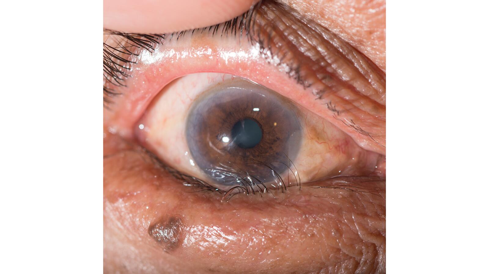 Entropion: Symptoms, Types, Causes, and Treatment