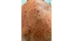 Kidney Disease Rash: Pictures, Symptoms, Causes, and Treatments