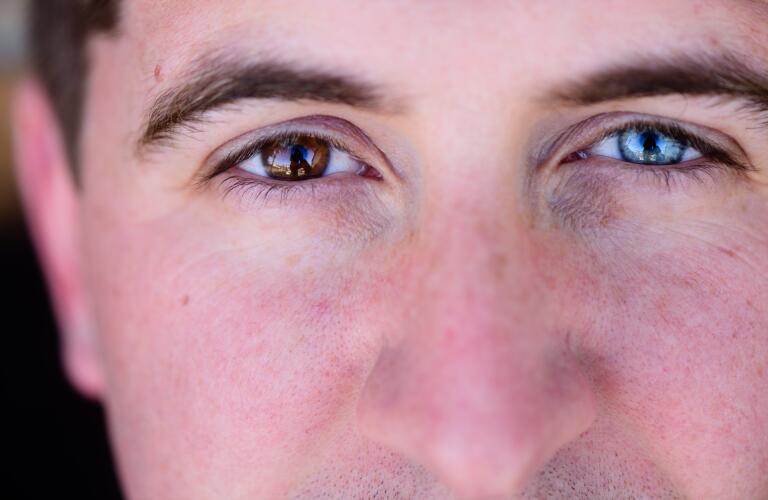 Heterochromia in Eyes: What It Is, Types & What Causes It - Healthgrades