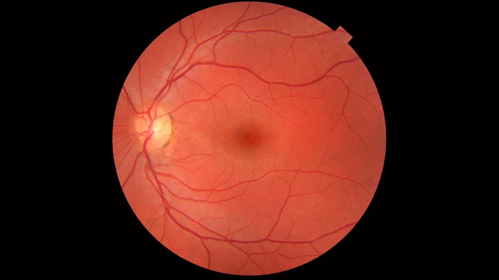 What Is Stargardt Disease? Symptoms, Causes, and Treatment