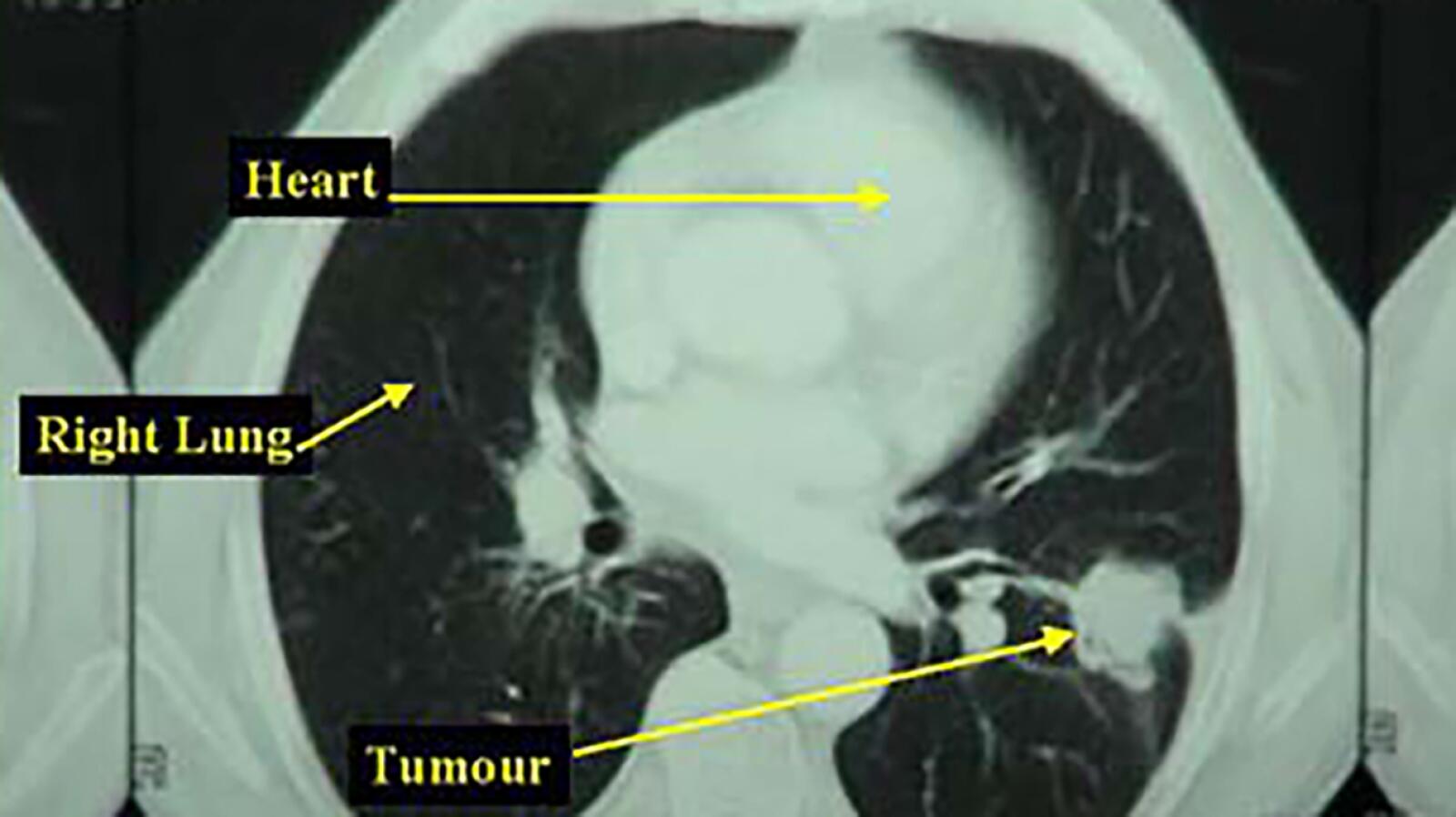 Real Lung Cancer Pictures X Rays And Types