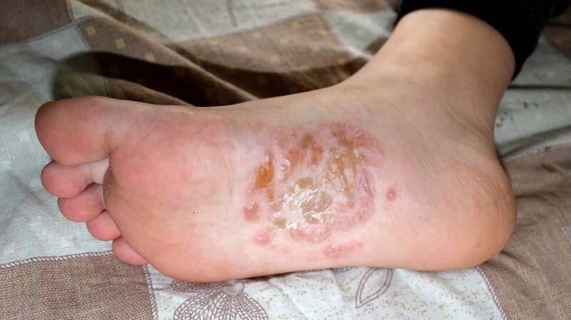 Eczema Blisters: Types, Causes, and Treatments