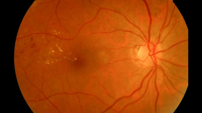 Stages of Macular Degeneration: Symptoms, Treatment, Outlook