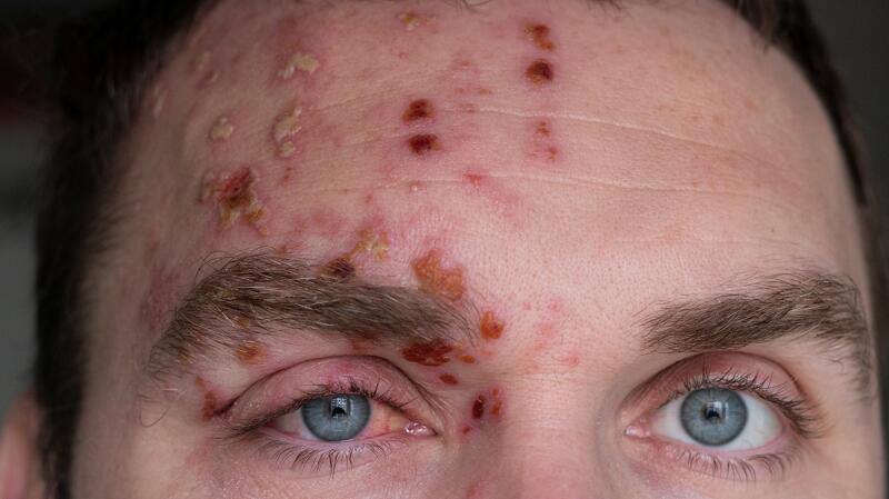 Shingles on the Face: What It Can Look Like