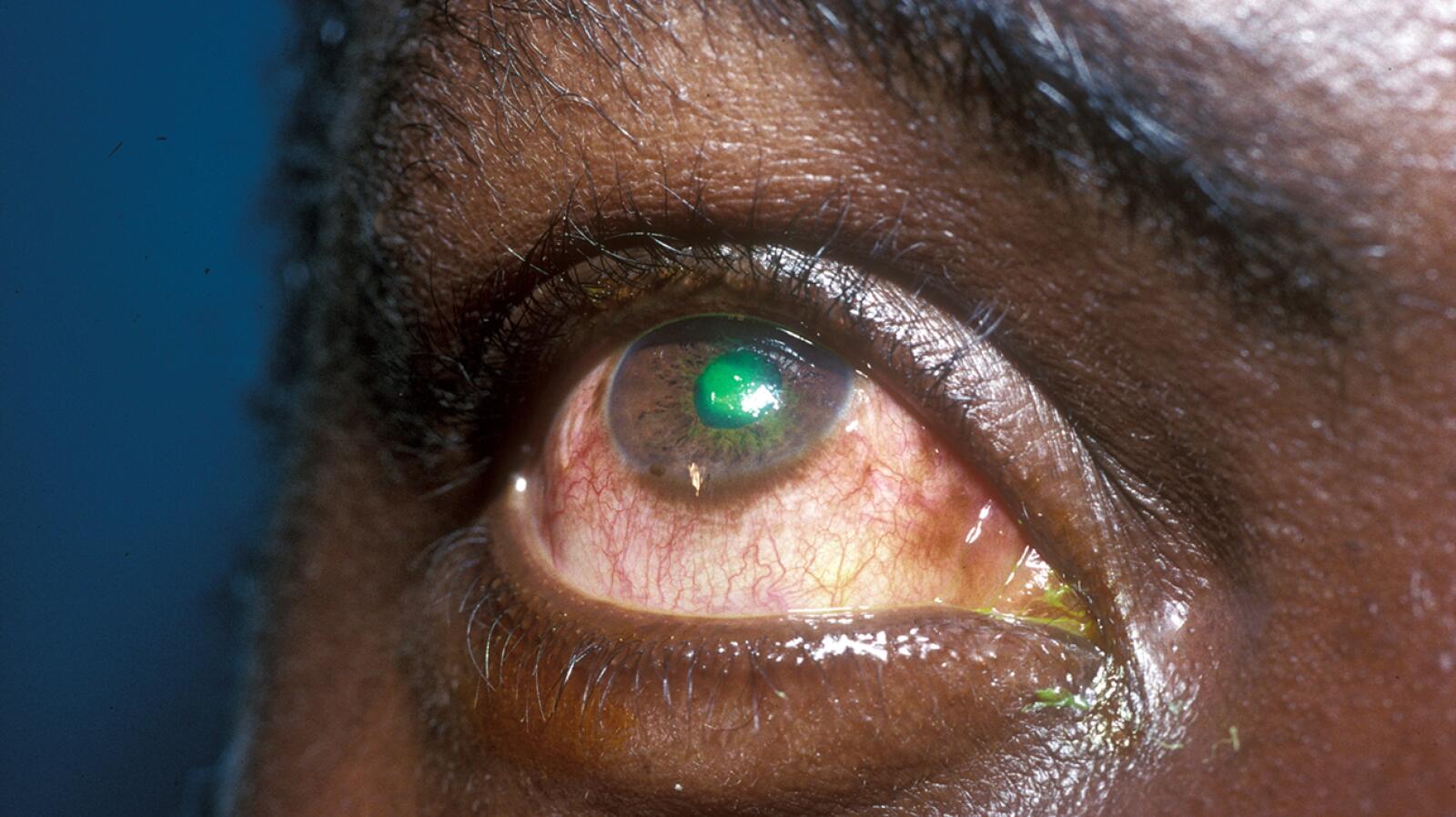 Corneal Ulcer (Keratitis): Symptoms, Causes, Treatment