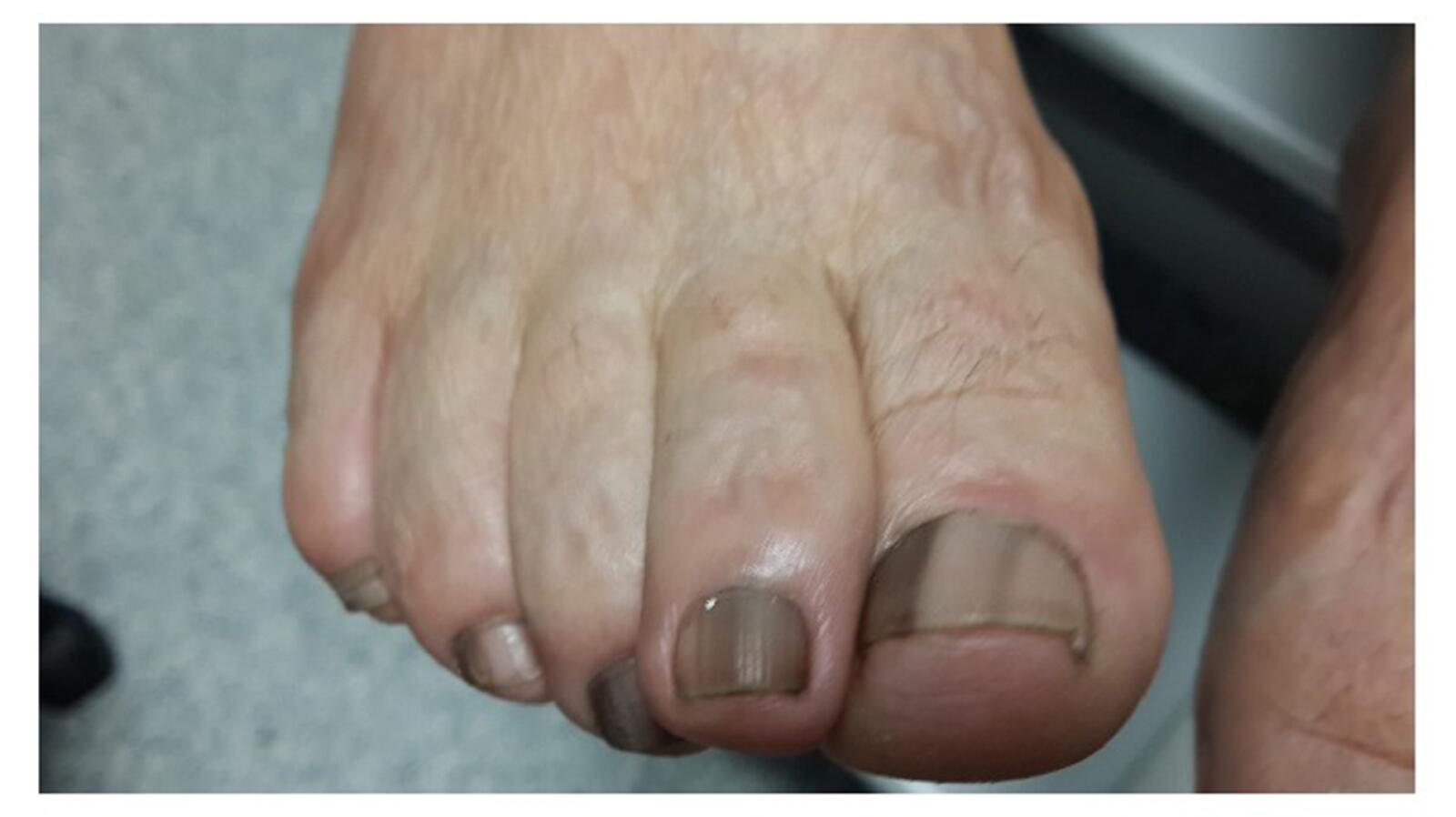 Melanonychia: Pictures, Types, Symptoms, Causes, and More