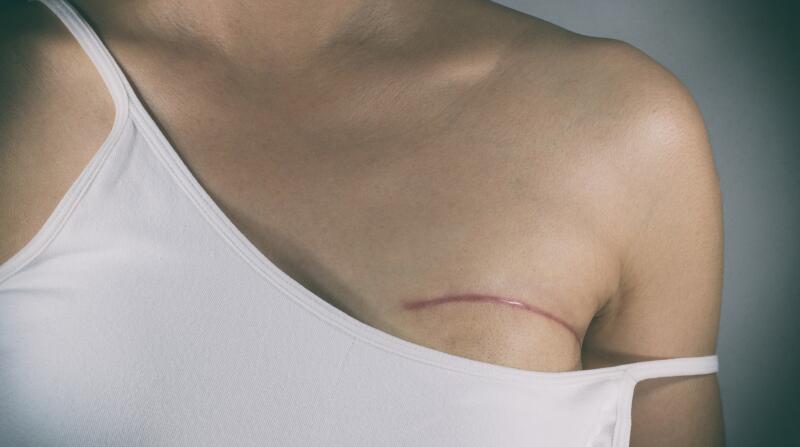 why are mastectomy scars so bad