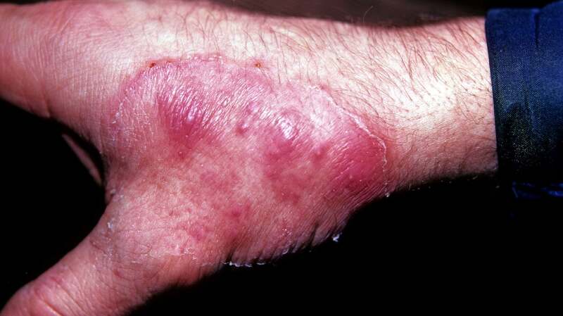 Tinea Manuum: Symptoms, Causes, Treatment, and More