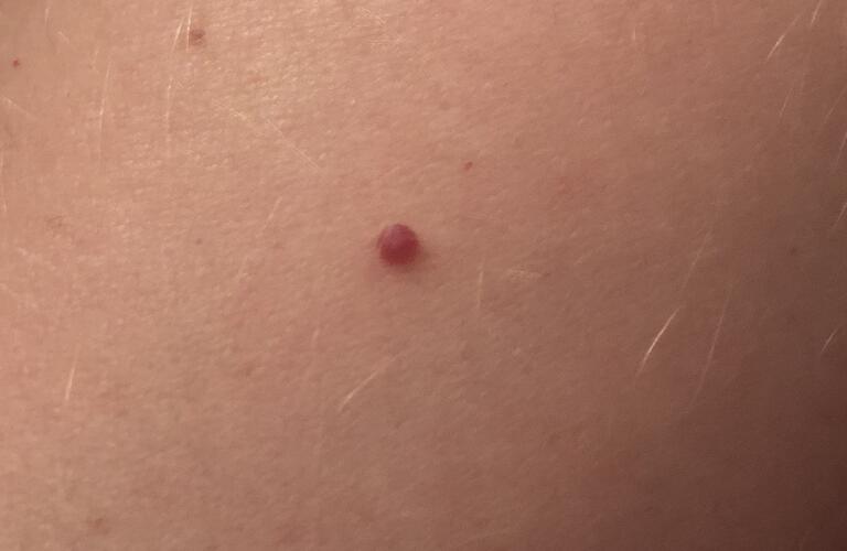 cherry red spot cause