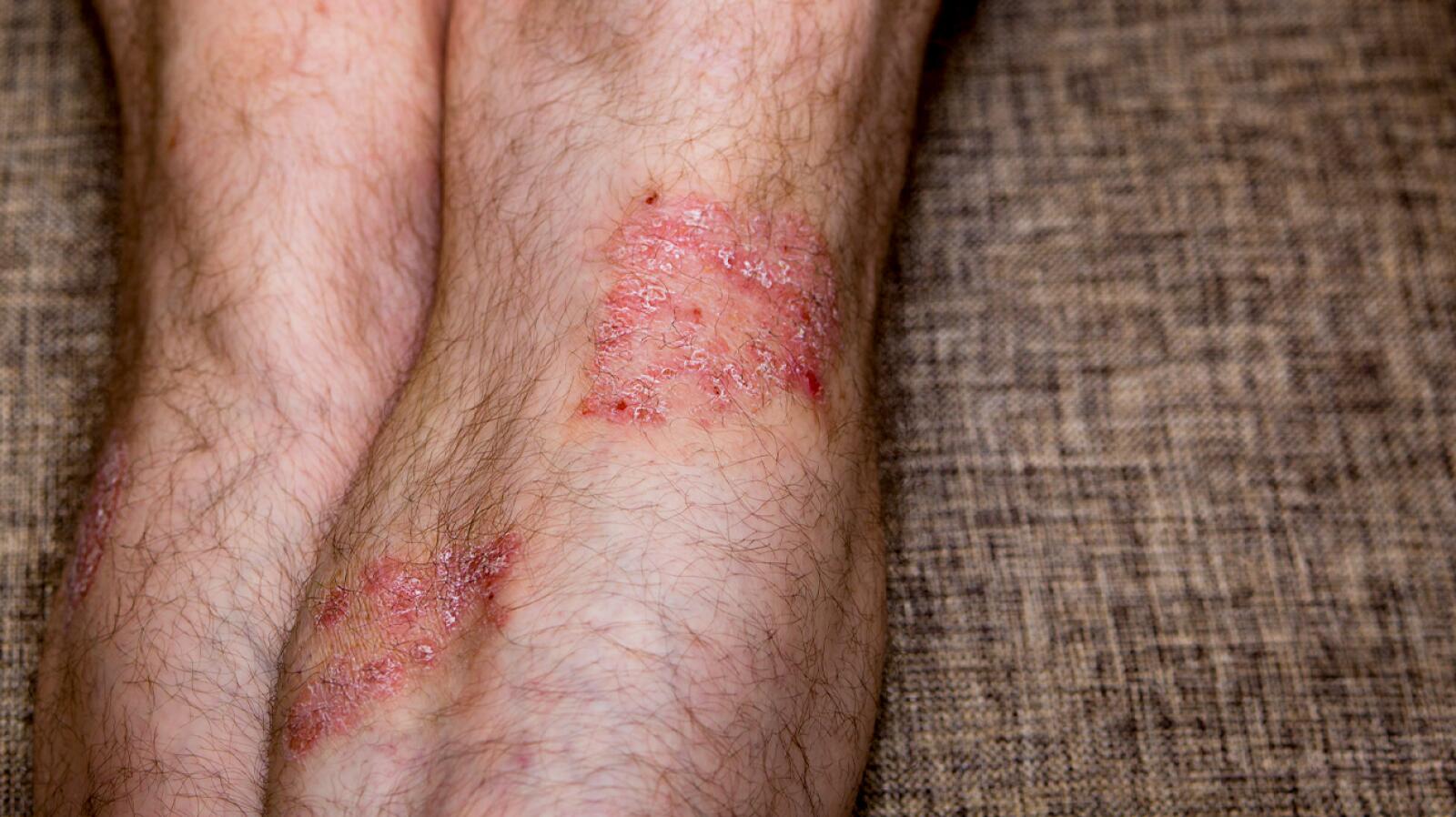 Rash on Legs: Causes and Treatment