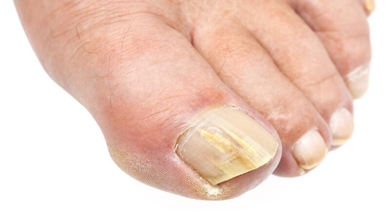 7 Things to Know About Toenail Fungus | Onychomycosis