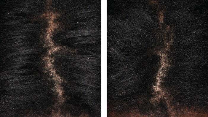 Dandruff vs. Dry Scalp: Causes, Treatment, and Main Differences