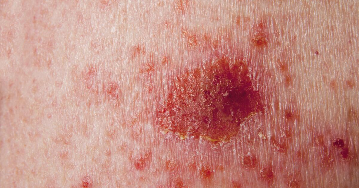 Scurvy - Symptoms, Causes, Treatments