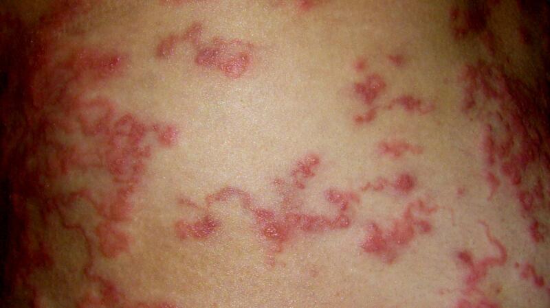 Skin Infections: Symptoms, Causes, Treatment, and More