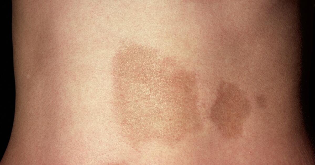 Morphea: Symptoms, Causes & Treatment | Types of Morphea