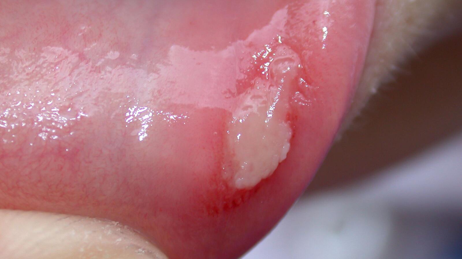 Behcet's Disease: Symptoms, Causes, Outlook, and More