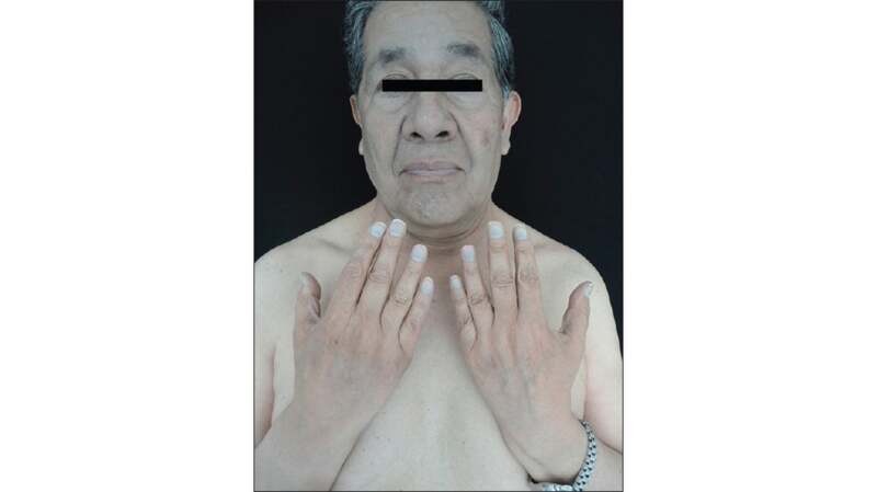 Argyria: Definition, Symptoms, Causes, Treatments, and More