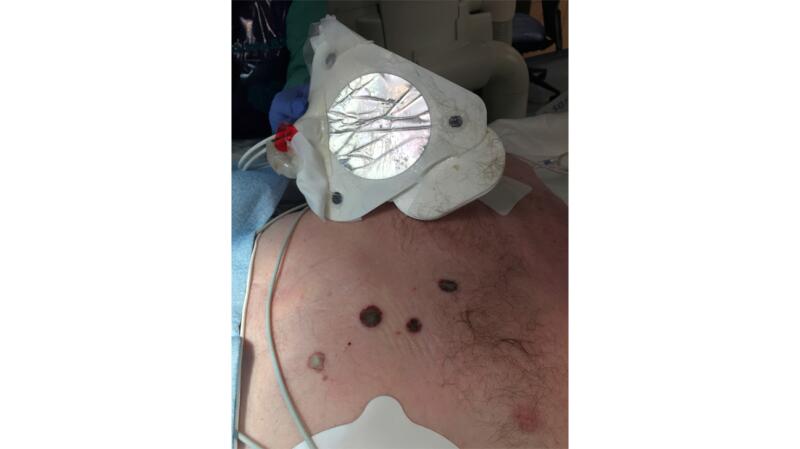 Third-Degree Burn: Causes, Symptoms, and Treatment