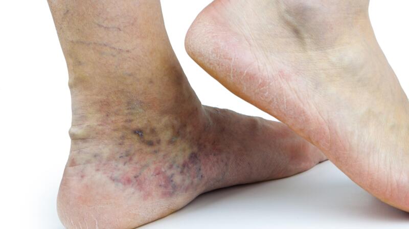 8 Things to Know About Varicose and Spider Veins