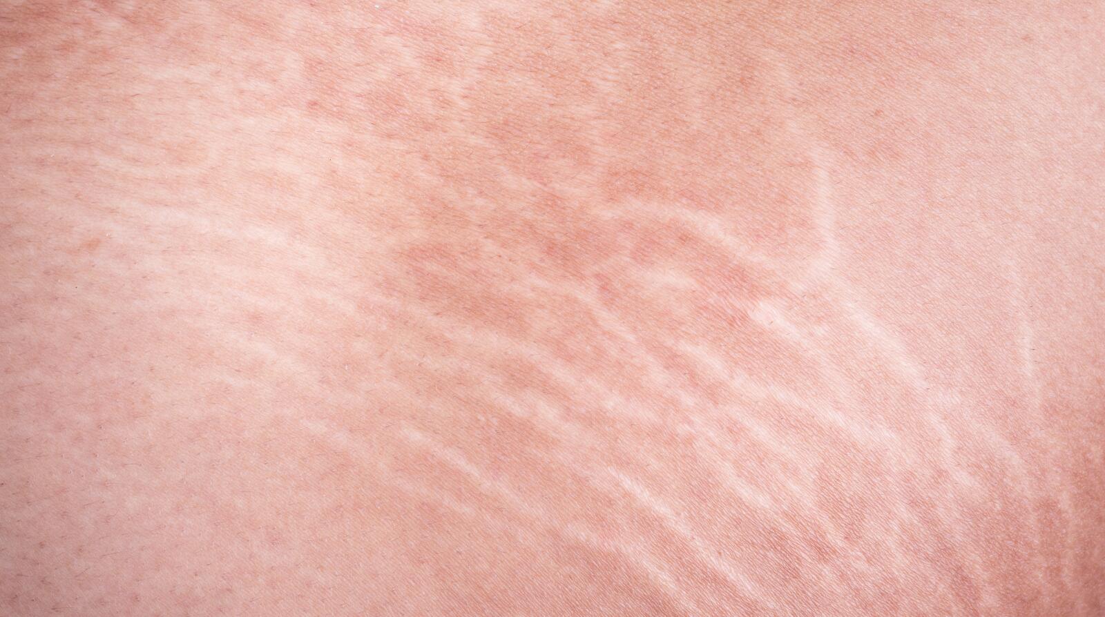 9 Things to Know About Stretch Marks: Causes & Treatments