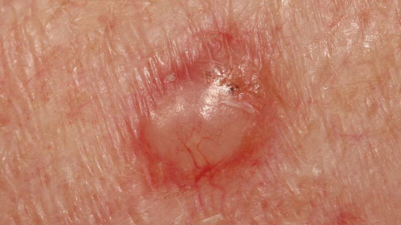 Images of Basal Cell Carcinoma: Pictures by Stage and Type