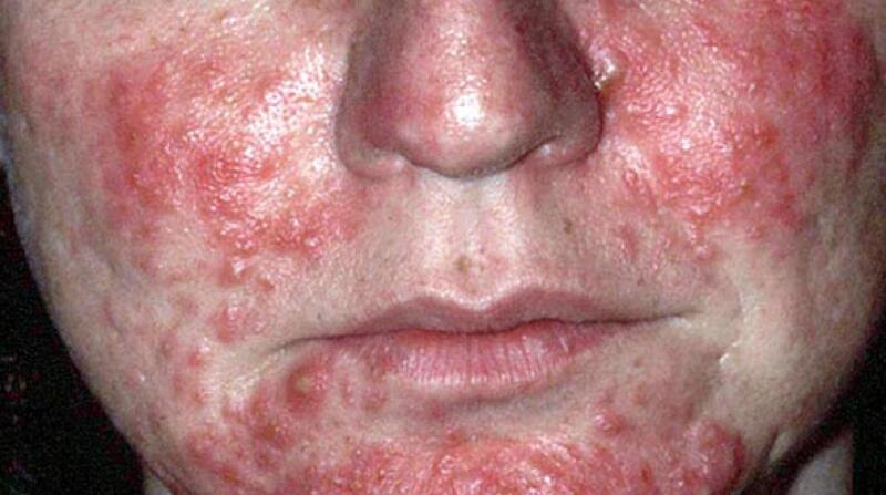 severe rosacea