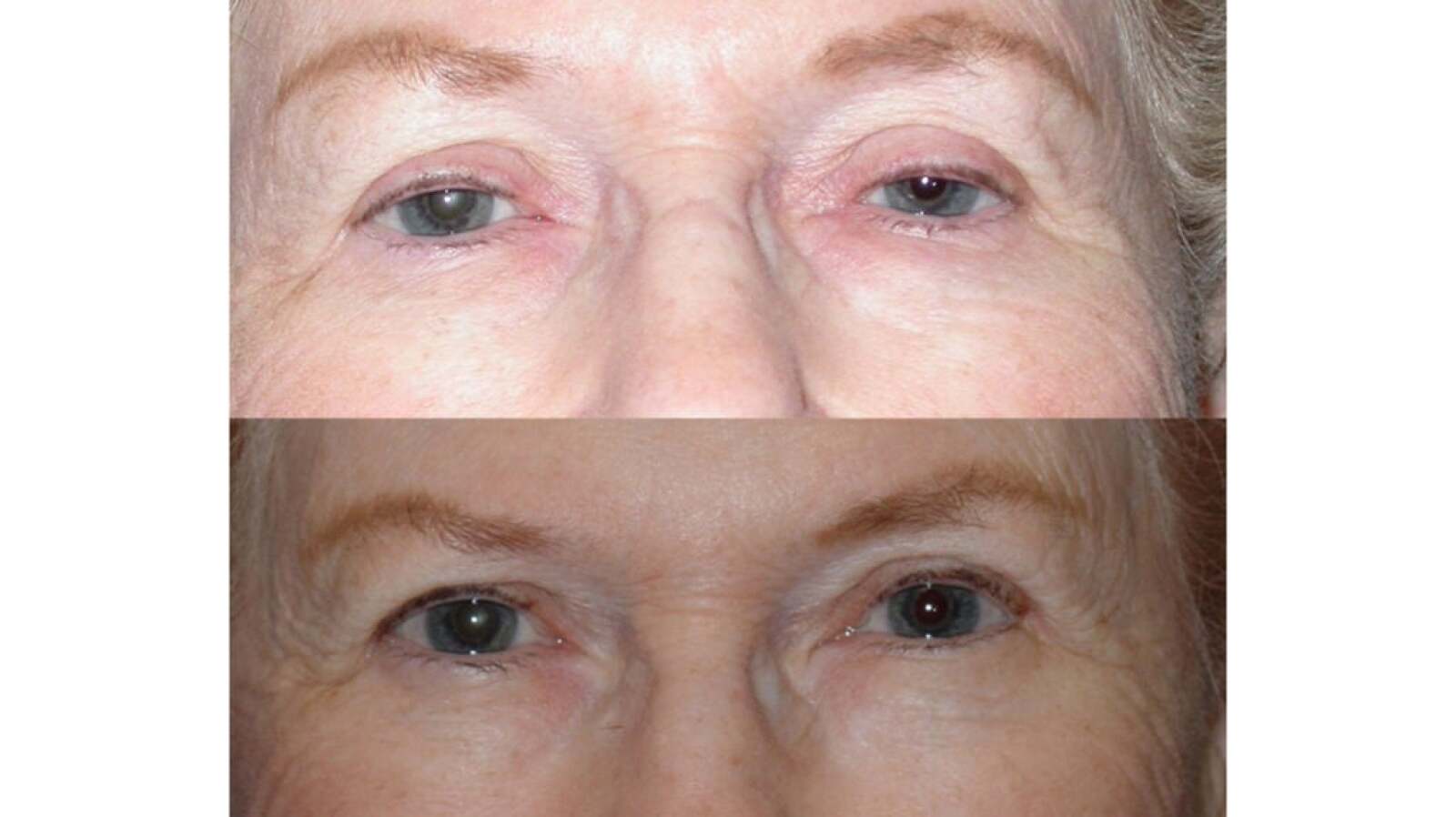 Ptosis: Causes, Symptoms, Diagnosis, and Treatments