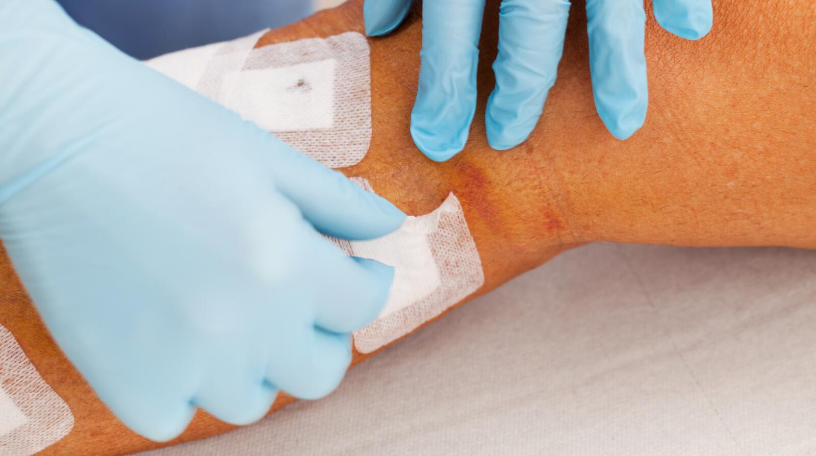 10 Tips for Recovering From Varicose Vein Surgery