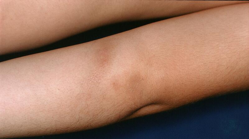 Morphea Facts | 5 Things to Know About Morphea