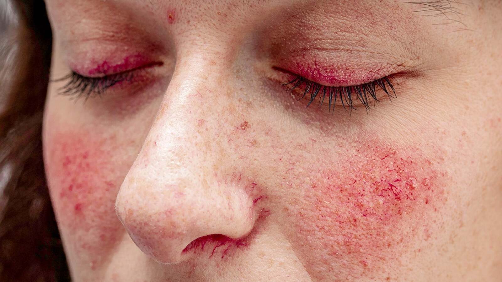 Lupus Rash Vs Rosacea Symptoms Causes Treatments