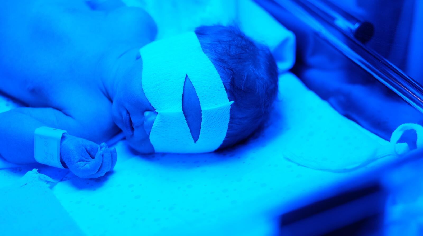 Hyperbilirubinemia | 9 Things to Know About Jaundice