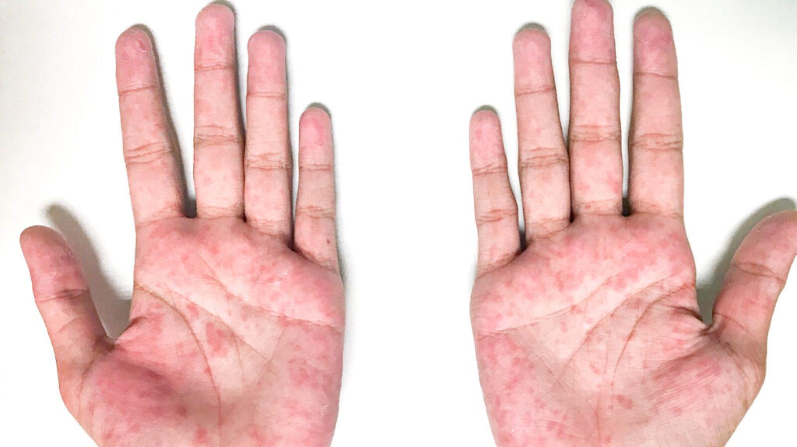 Palmar Erythema: Symptoms and Causes Palmar Erythema: Symptoms and Causes