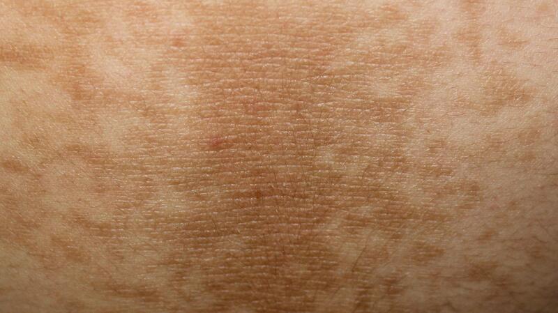 Acanthosis Nigricans: Appearance, Causes, and Treatment