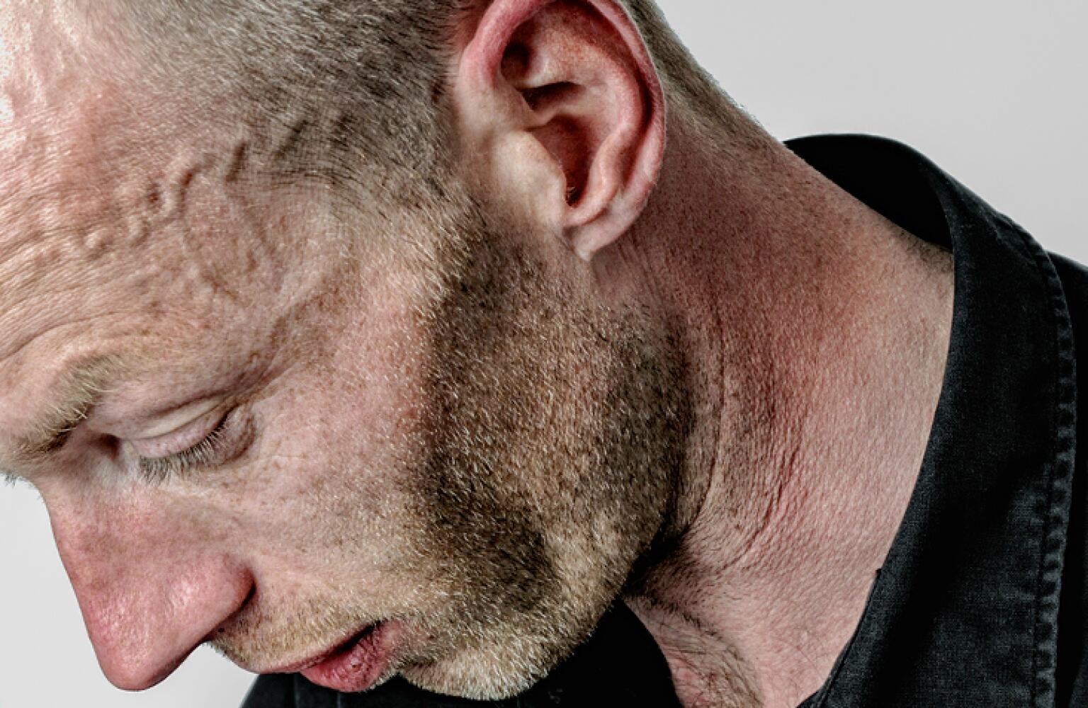 Tardive Dyskinesia Symptoms | Schizophrenia & Tardive Dyskinesia