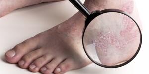 7 Types of Foot Rashes & How to Treat Them | Causes of Foot Rash