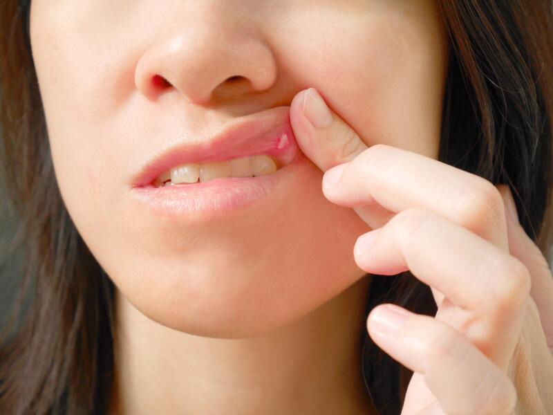 nicotinic stomatitis causes