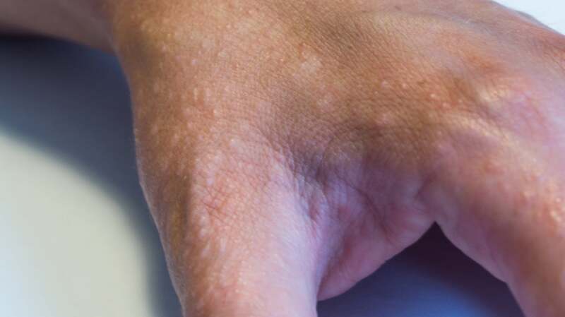 Eczema Blisters: Types, Causes, and Treatments