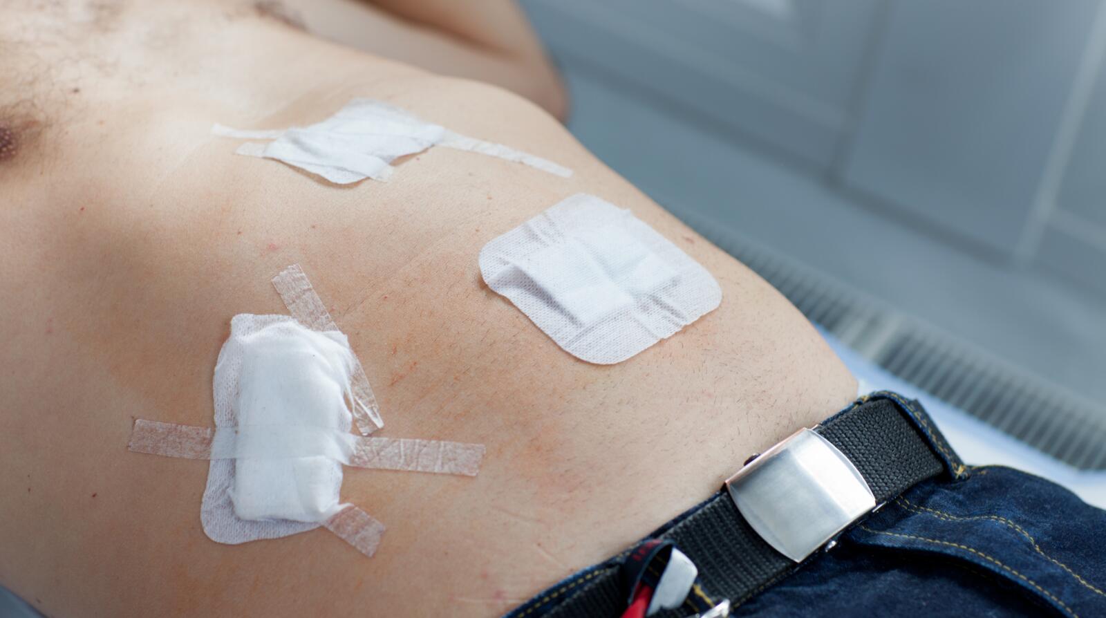 9 Things to Know About Gallbladder Removal | Cholecystectomy Facts