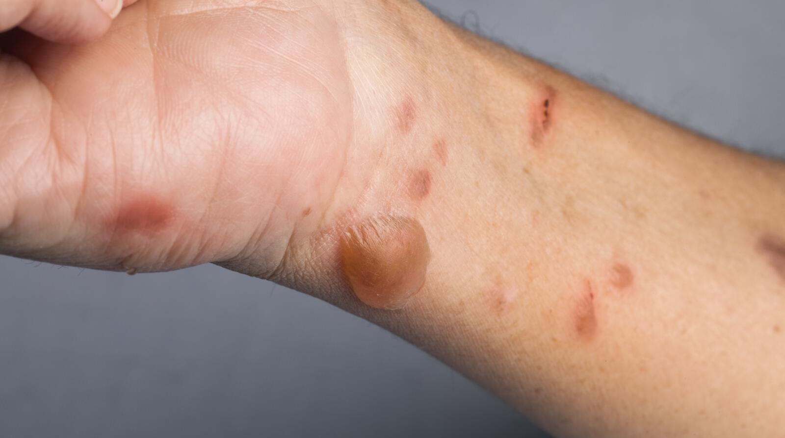 10 Things to Know About Burns | How to Treat 2nd and 3rd Degree Burns