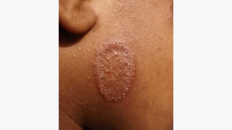 Ringworm vs. Eczema: Symptoms, Causes, Treatments