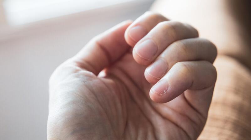 Hangnail: Causes, Symptoms, and Treatment